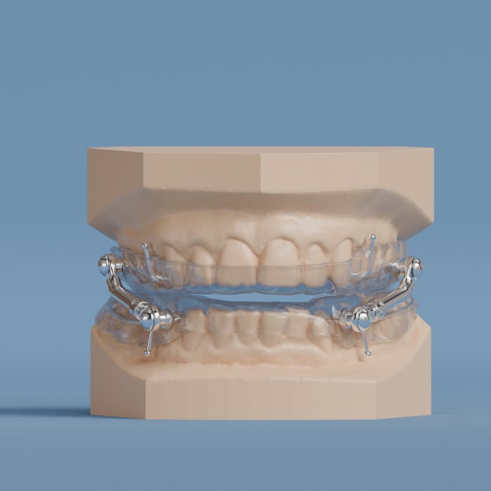 Hard Telescopic Sleep Herbst® :: Great Lakes Dental Technologies